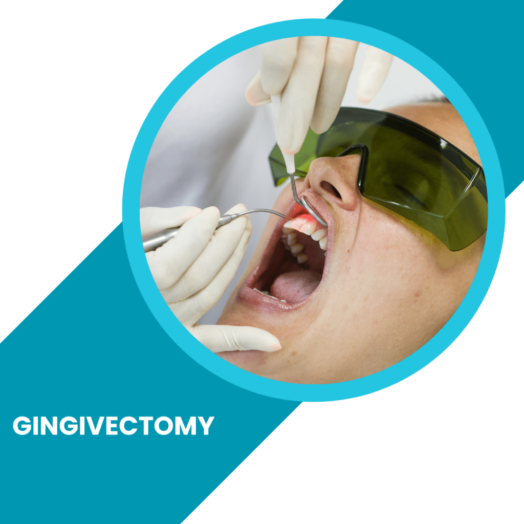 Gingivectomy - What it is and How Much it Costs!