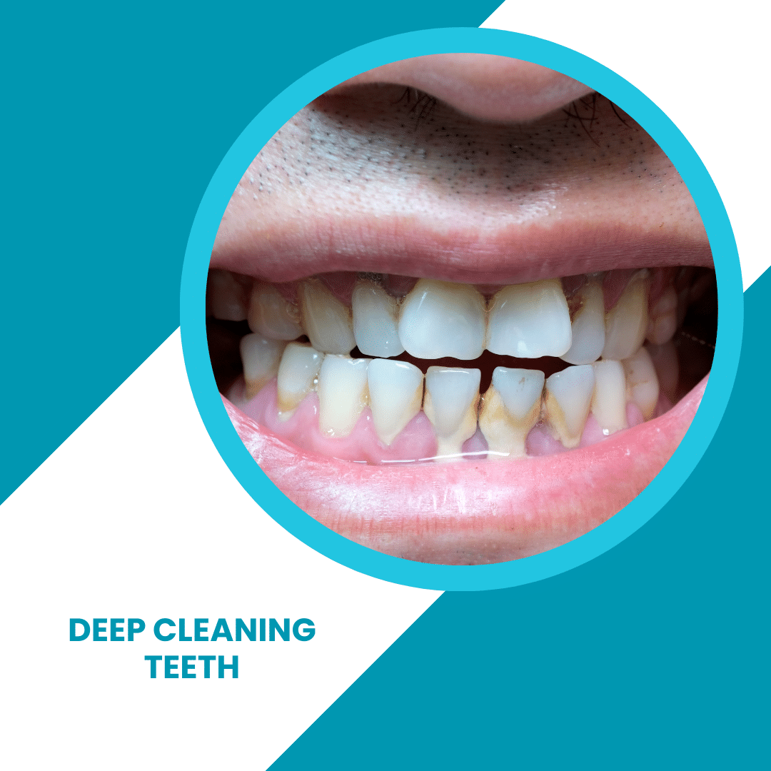 Deep Cleaning Teeth ToothFeed